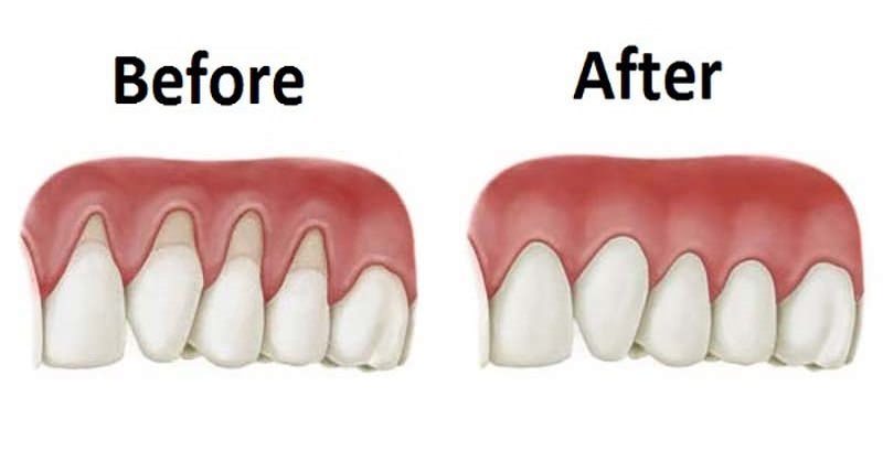 How to Use These 4 Natural Remedies For Curing Receding Gums - Holistic ...